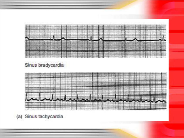 AED & Basic ECG - Full Basic Life Support 2016 | PPT
