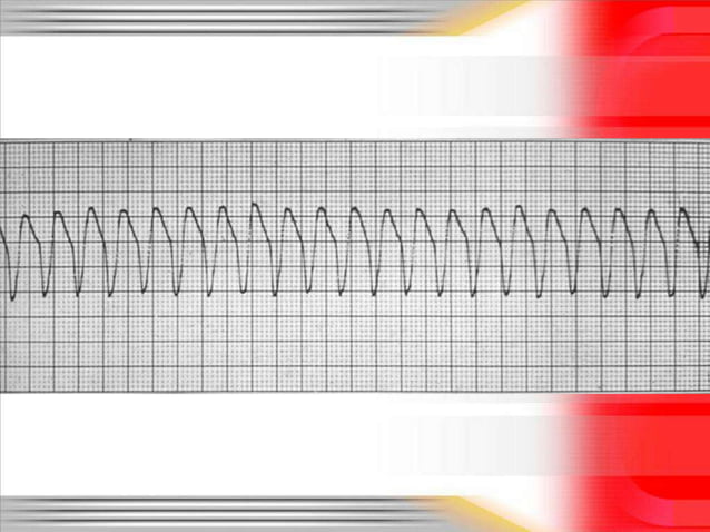 AED & Basic ECG - Full Basic Life Support 2016 | PPT