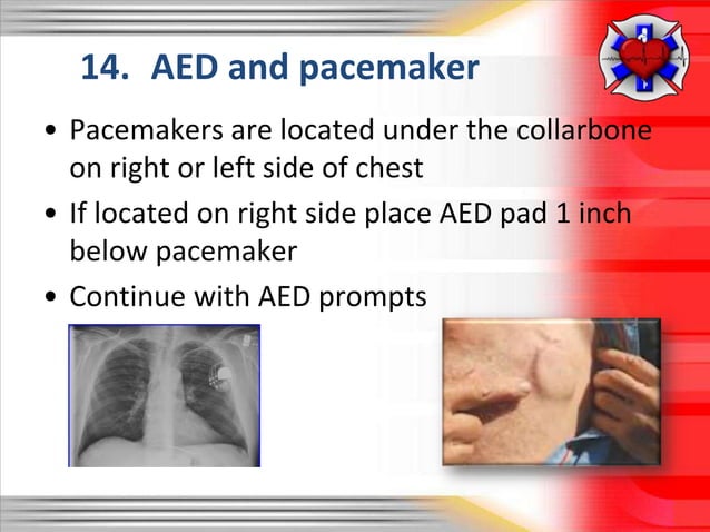 AED & Basic ECG - Full Basic Life Support 2016 | PPT
