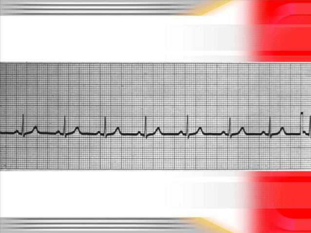 AED & Basic ECG - Full Basic Life Support 2016 | PPT