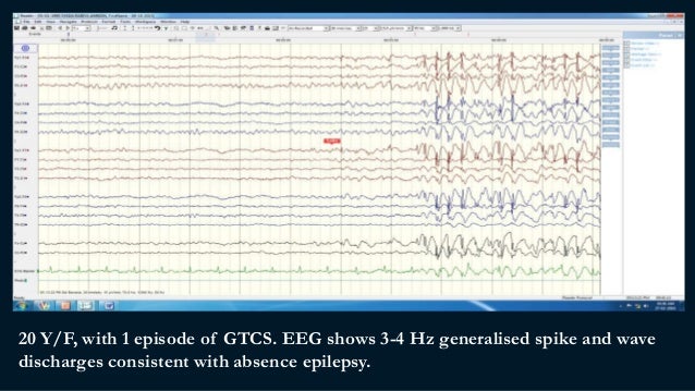 When to start and when to stop AEDs