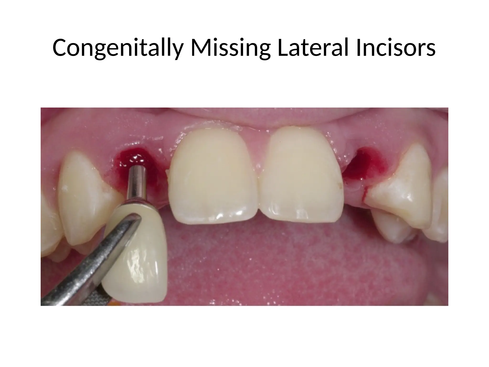 Management of Congenitally Missing Bilateral Lateral Incisors with ...