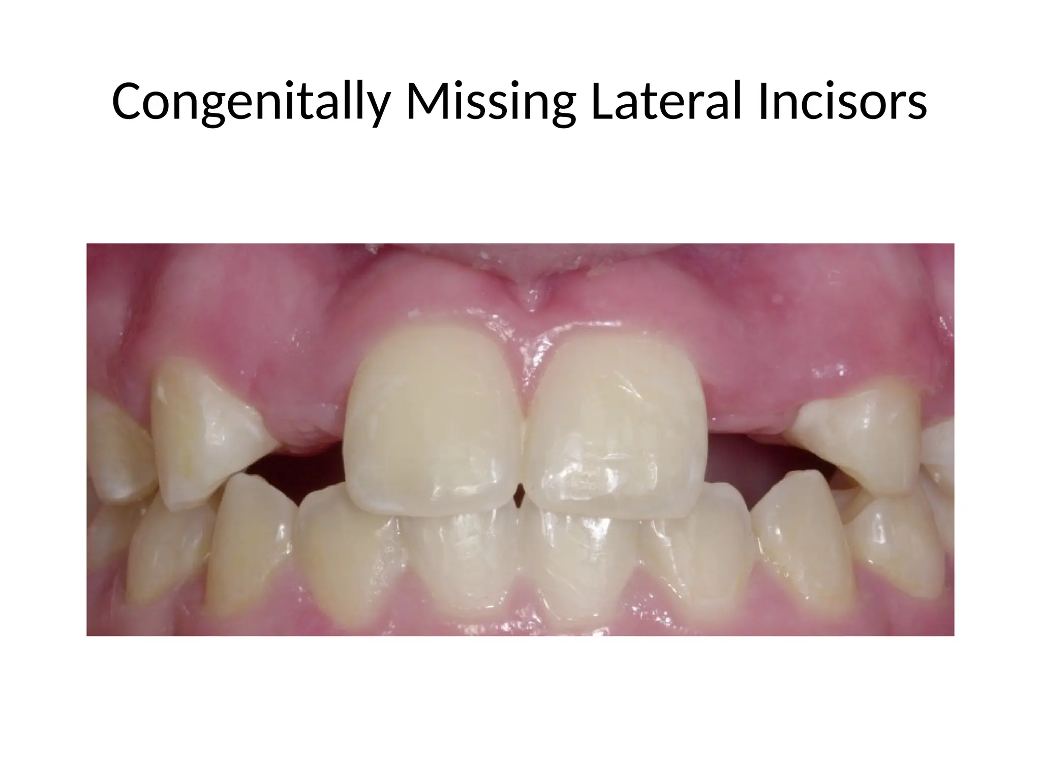 Management of Congenitally Missing Bilateral Lateral Incisors with ...
