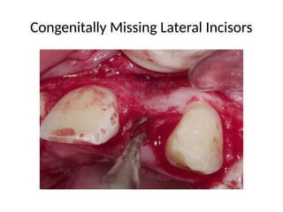 Management of Congenitally Missing Bilateral Lateral Incisors with ...