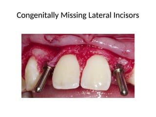 Management of Congenitally Missing Bilateral Lateral Incisors with ...