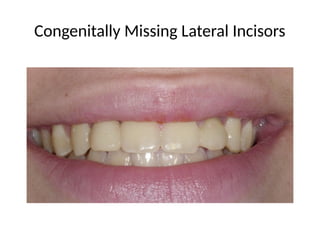Management of Congenitally Missing Bilateral Lateral Incisors with ...