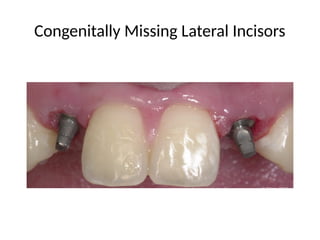 Management of Congenitally Missing Bilateral Lateral Incisors with ...