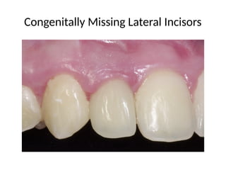 Management of Congenitally Missing Bilateral Lateral Incisors with ...