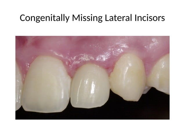 Management of Congenitally Missing Bilateral Lateral Incisors with ...