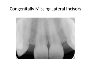 Management of Congenitally Missing Bilateral Lateral Incisors with ...