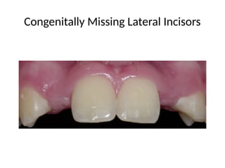 Management of Congenitally Missing Bilateral Lateral Incisors with ...