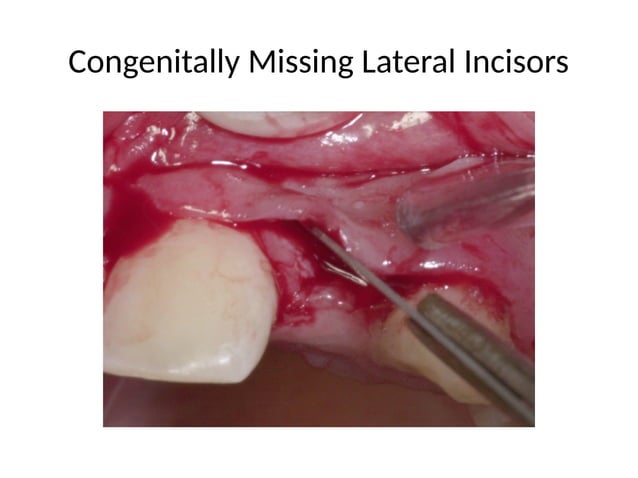 Management of Congenitally Missing Bilateral Lateral Incisors with ...