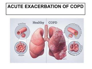 Ae in copd | PPTX