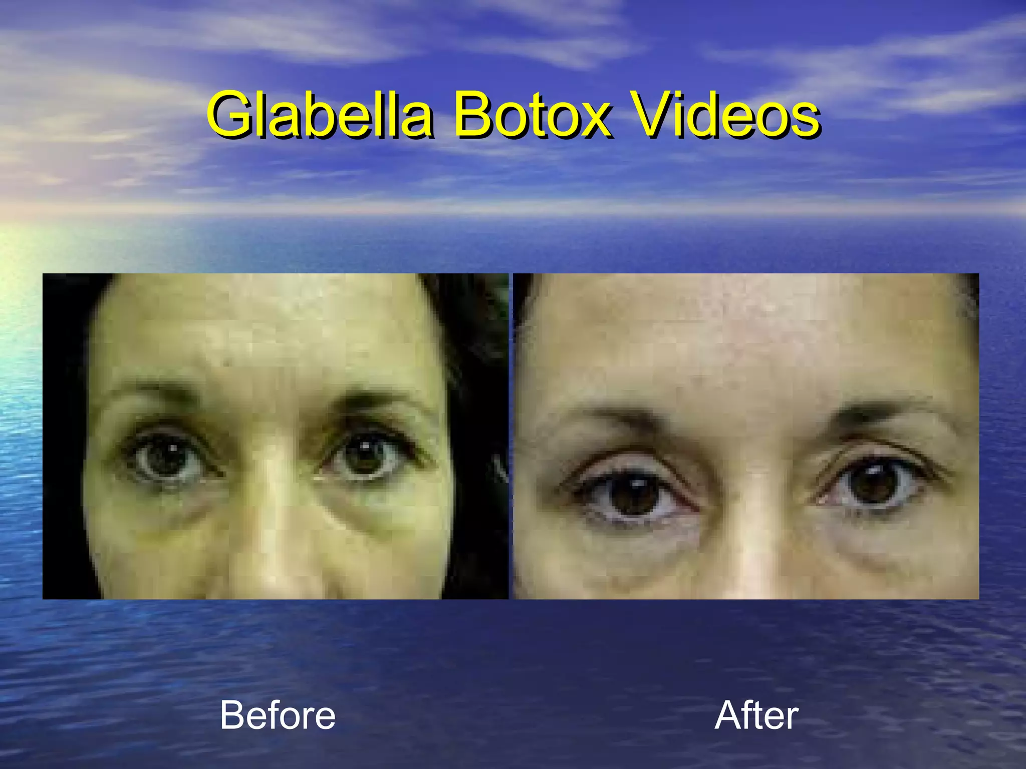 Botox video documentation | PPT