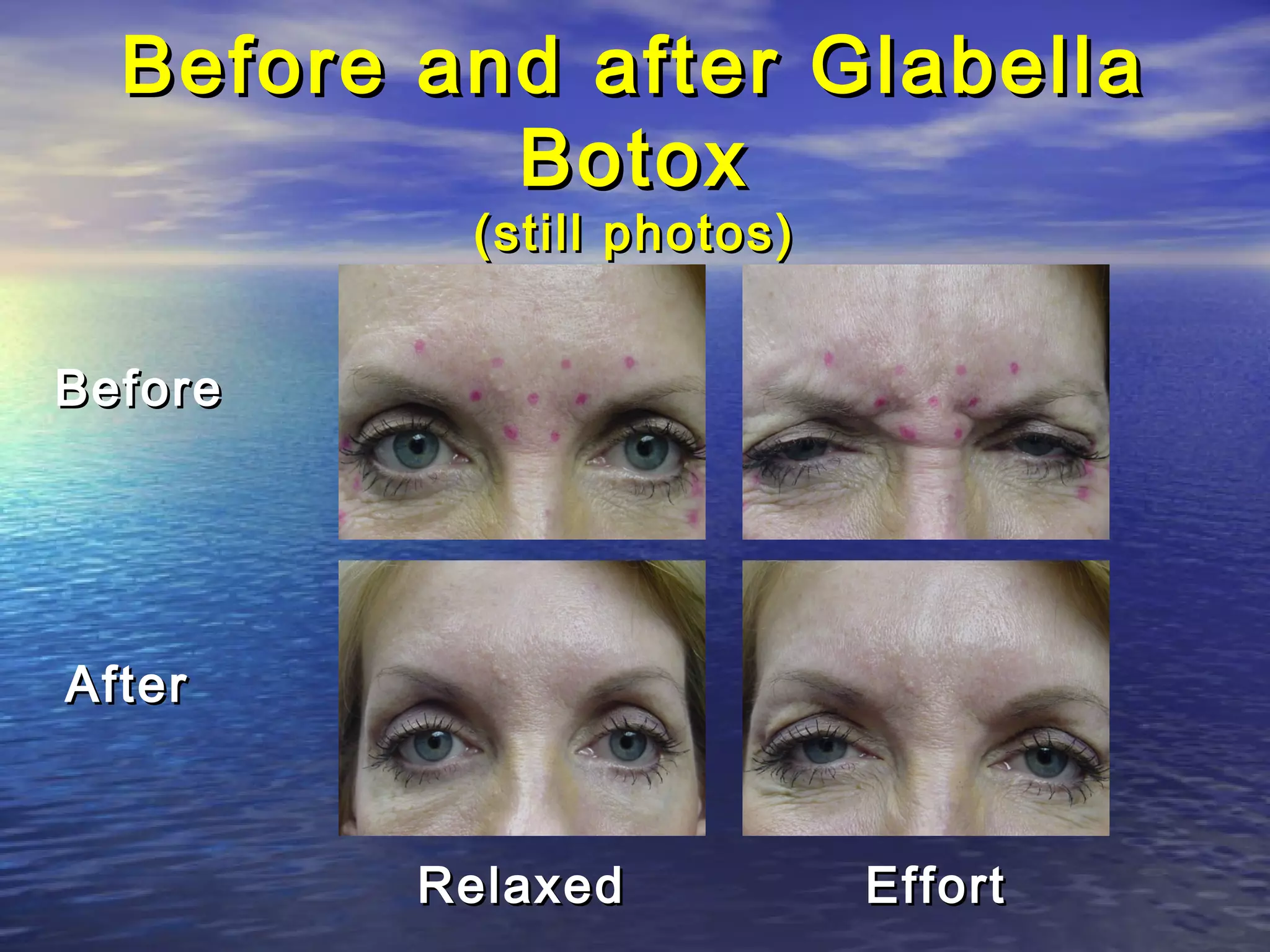 Botox video documentation | PPT