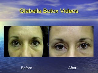 Botox video documentation | PPT