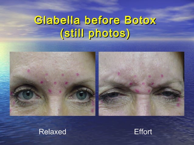 Botox video documentation | PPT