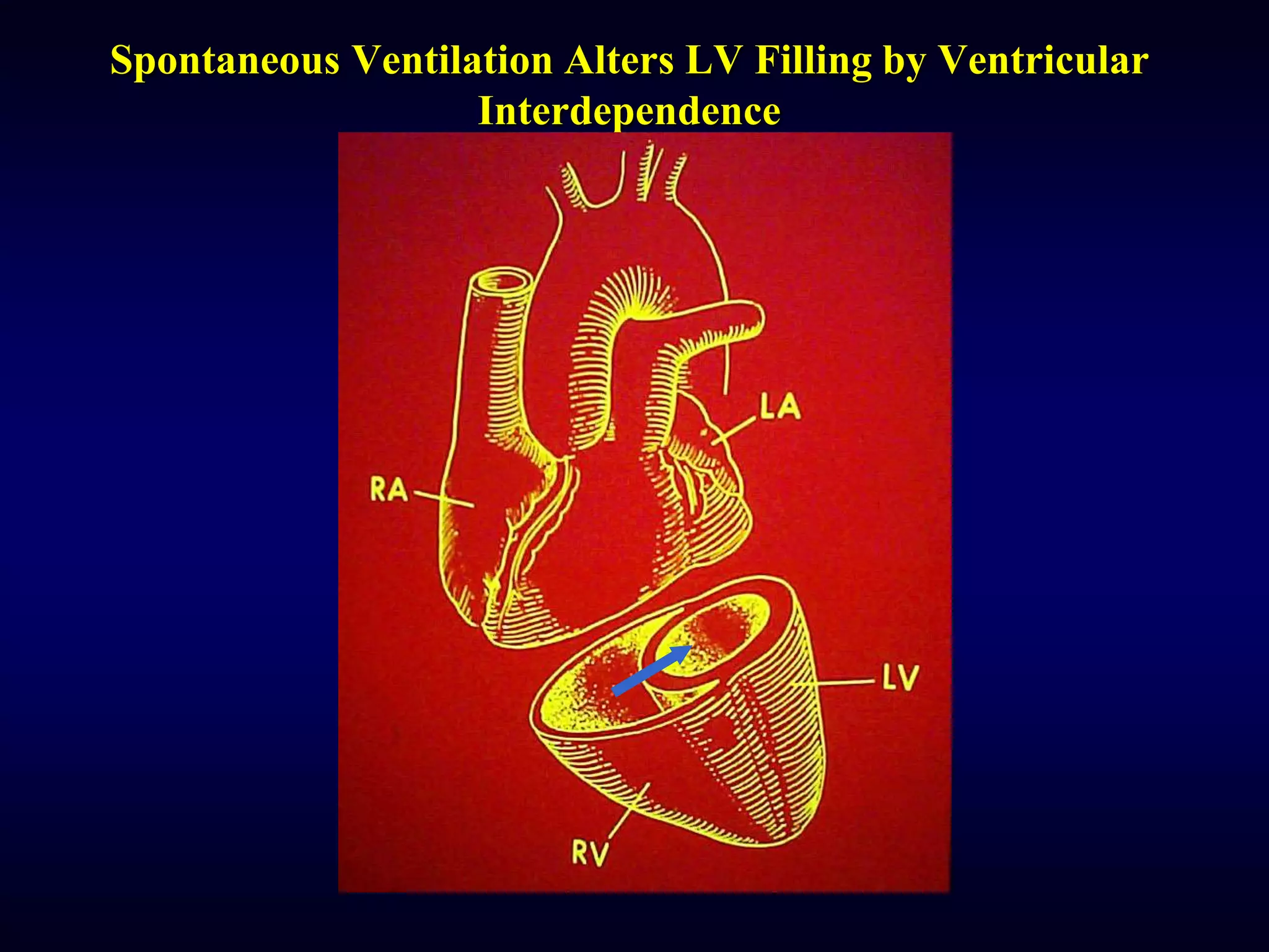 Acute right heart failure: Adaptation, interdependence and external ...