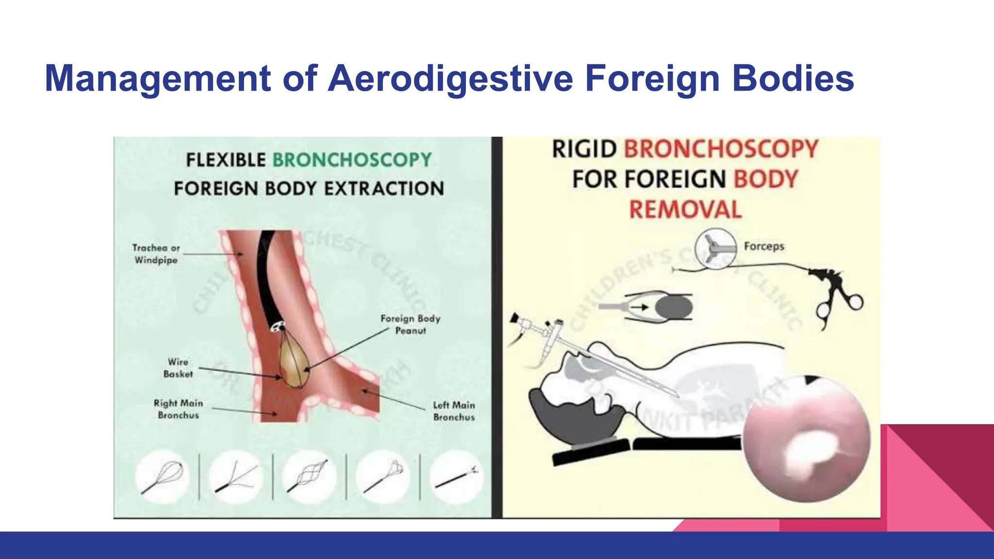 Aerodigestive Foreign Bodies Of the Nose and Throat.pptx