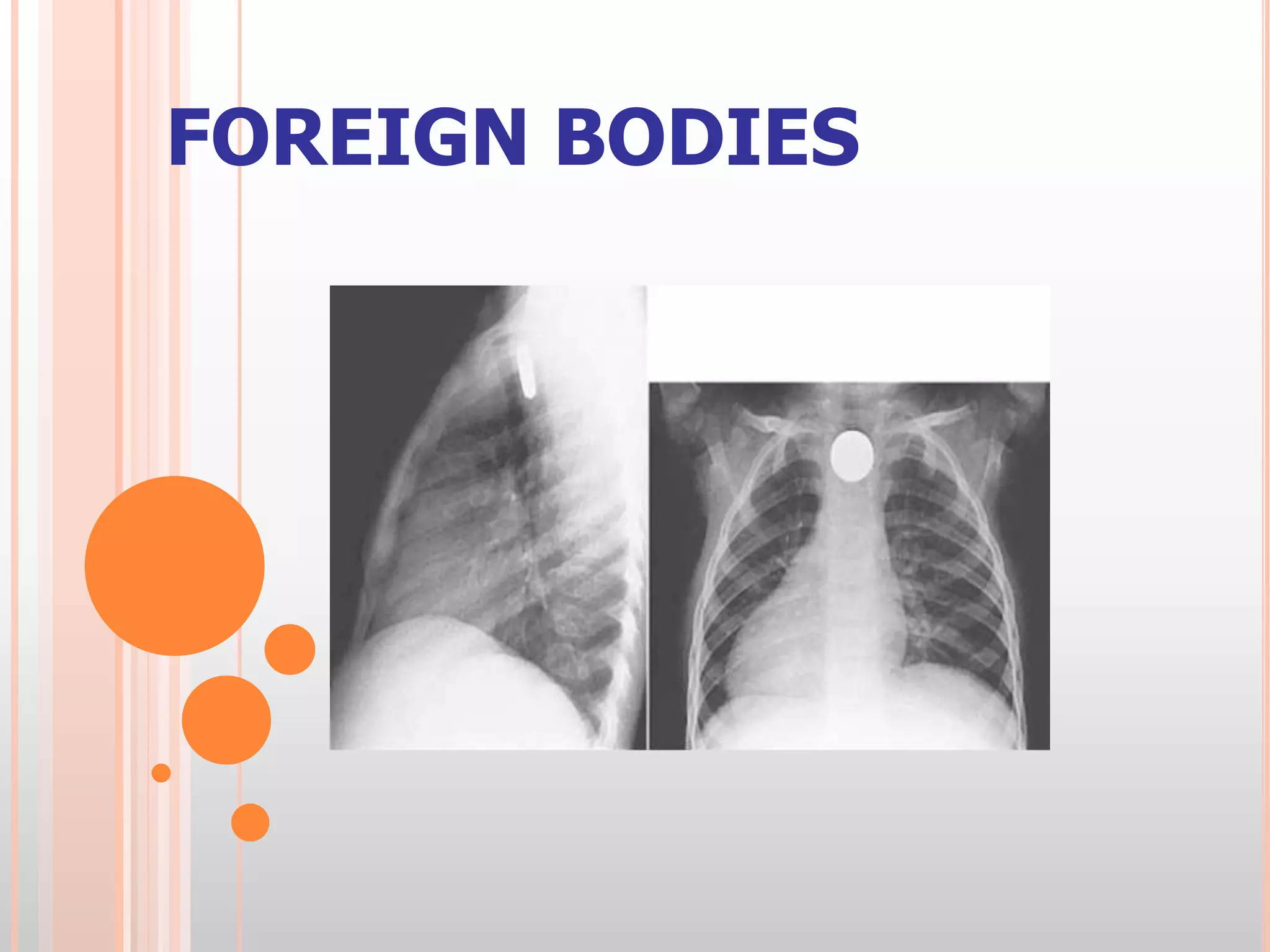 Aerodigestive_Foreign_Bodies_AMendelsohn_3-25-09_0.ppt