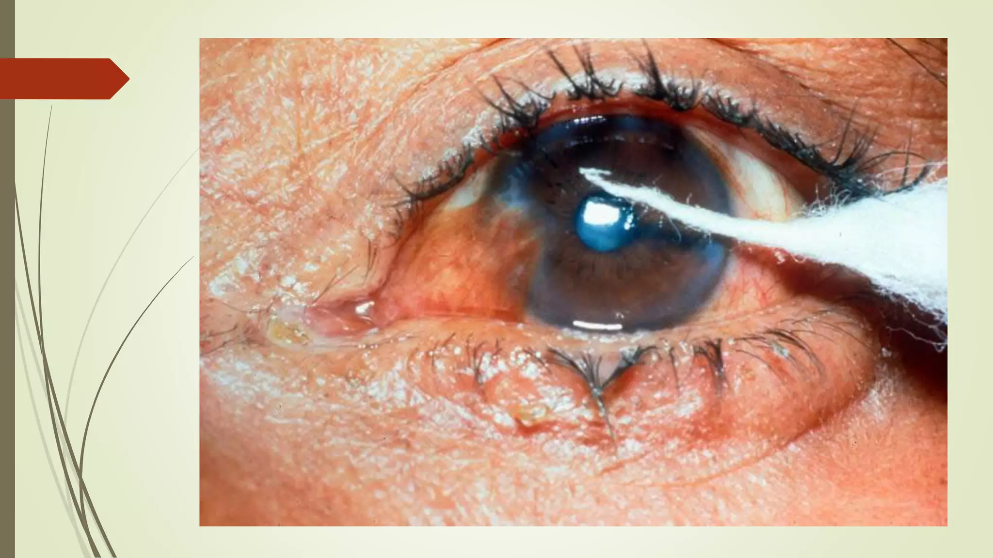 Aesthesiometer | PPTX