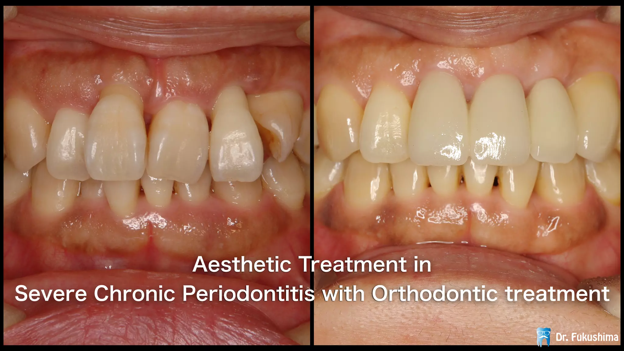 Aesthetic Treatment in Severe Chronic Periodontitis with Orthodontic ...