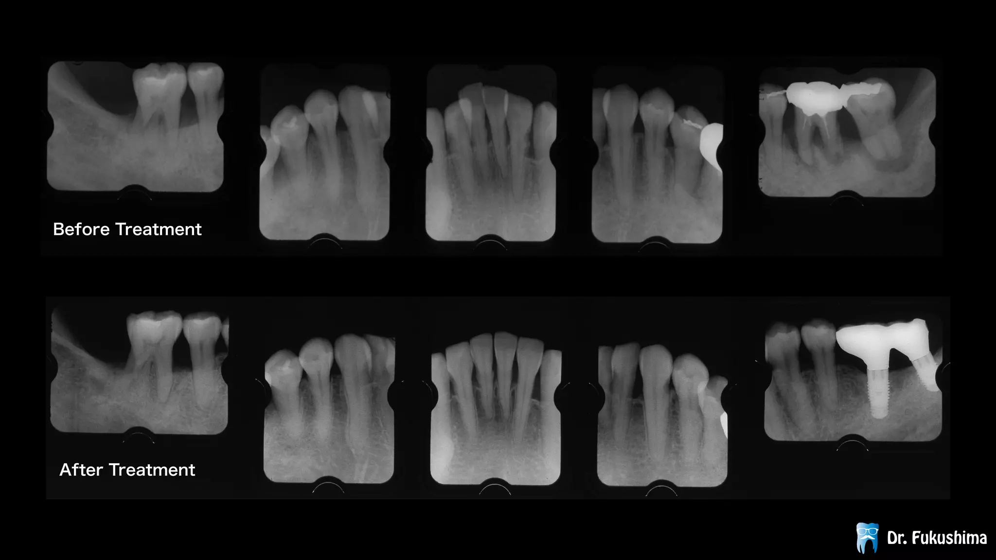 Aesthetic Treatment in Severe Chronic Periodontitis with Orthodontic ...