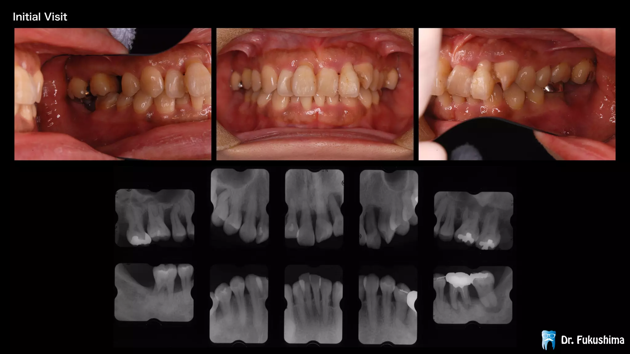 Aesthetic Treatment in Severe Chronic Periodontitis with Orthodontic ...