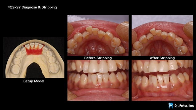 Aesthetic Treatment in Severe Chronic Periodontitis with Orthodontic ...