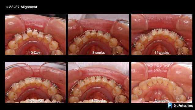 Aesthetic Treatment in Severe Chronic Periodontitis with Orthodontic ...