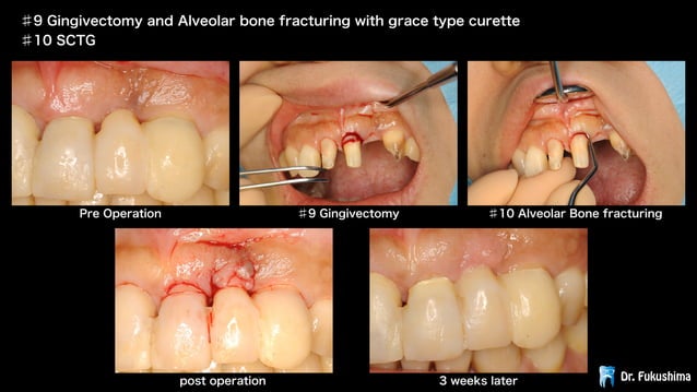 Aesthetic Treatment in Severe Chronic Periodontitis with Orthodontic ...