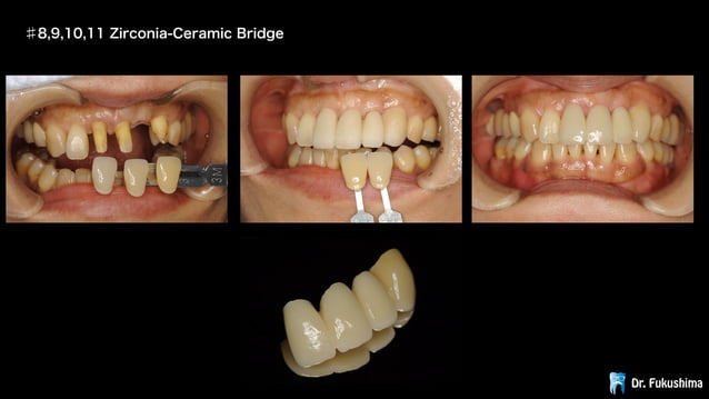 Aesthetic Treatment in Severe Chronic Periodontitis with Orthodontic ...