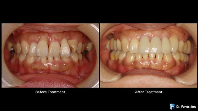 Aesthetic Treatment in Severe Chronic Periodontitis with Orthodontic ...