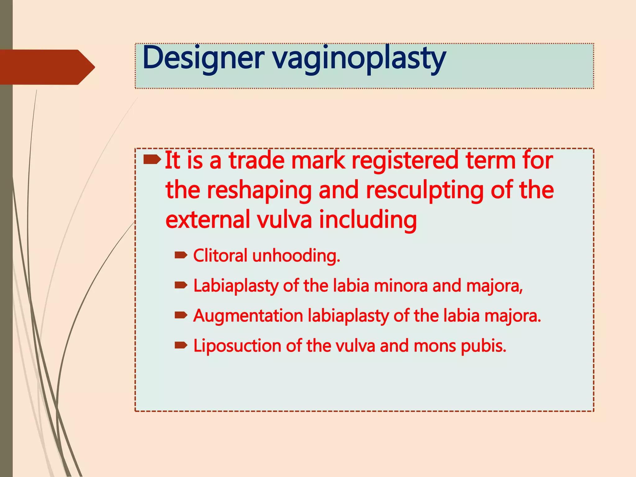 Aesthetic vaginoplasty | PPTX