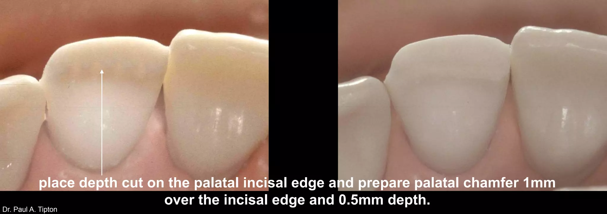 Tooth Preparation - Aesthetic veneers | PDF