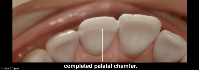 Tooth Preparation - Aesthetic veneers