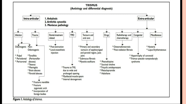 Aetiology and management of trismus | PPTX