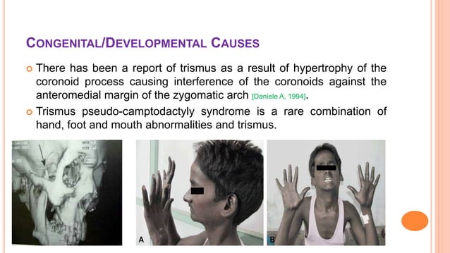 Aetiology and management of trismus | PPTX