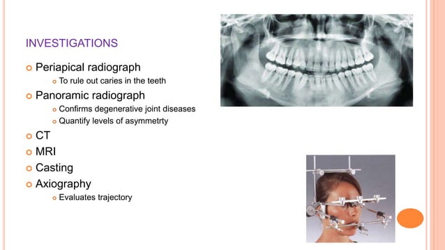 Aetiology and management of trismus | PPTX