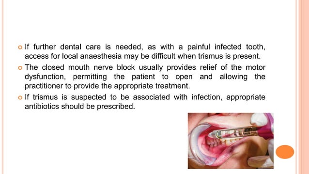 Aetiology and management of trismus | PPTX