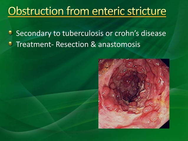 Aetiology of intestinal obstruction | PPTX | Digestive Disorders ...
