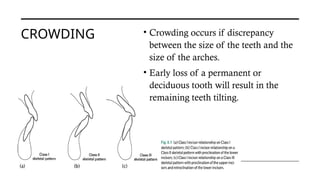 Aetiology of malocclusion CLASS I - MUNIRAH.pptx