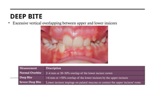 Aetiology of malocclusion CLASS I - MUNIRAH.pptx