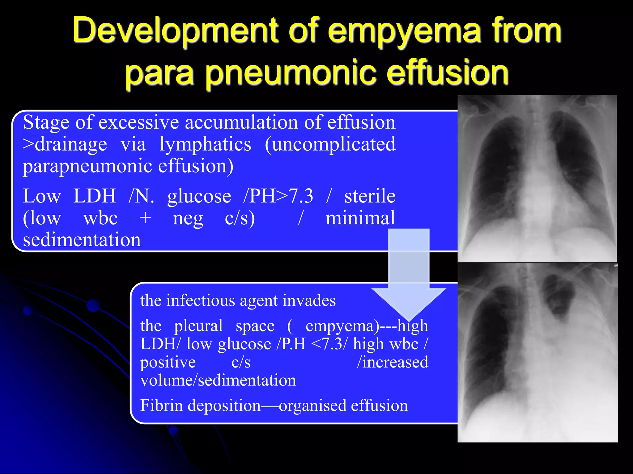 Aetiopathogenesis and management of empyema thoracis | PPTX