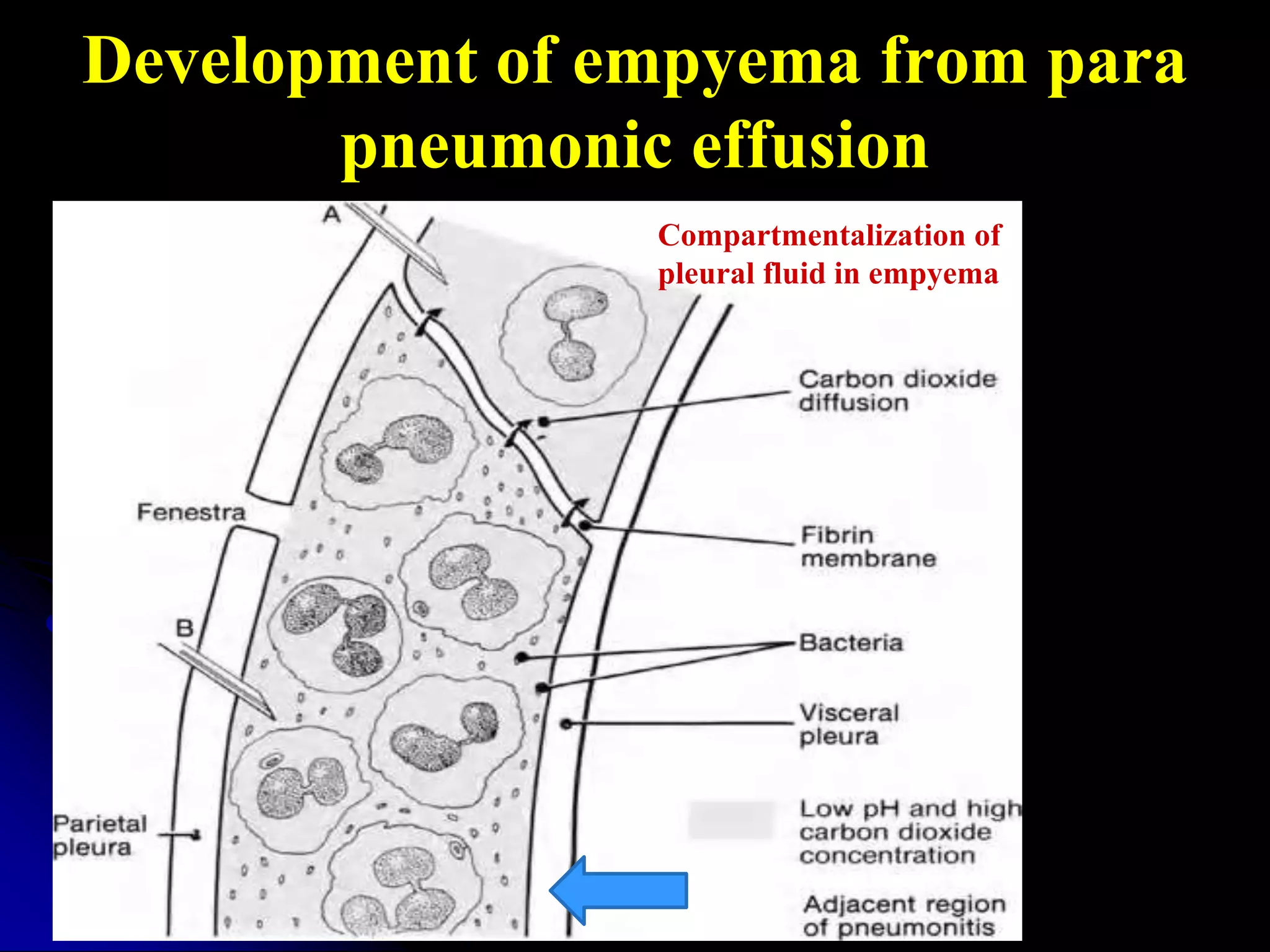 Aetiopathogenesis and management of empyema thoracis | PPTX