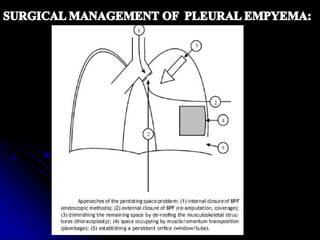 Aetiopathogenesis and management of empyema thoracis | PPTX