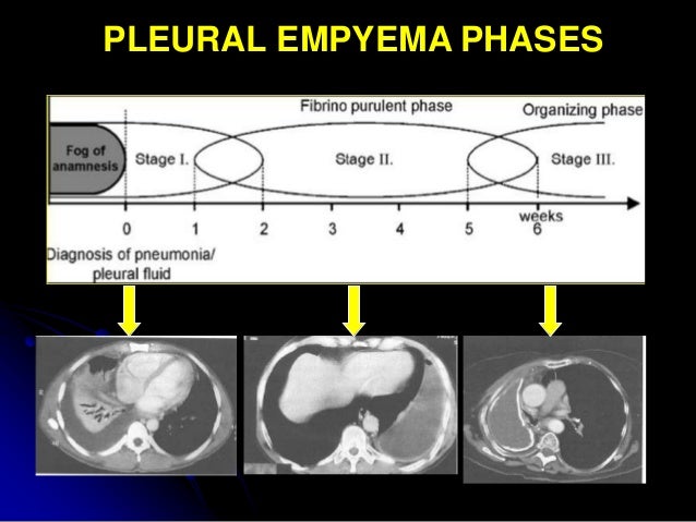 Aetiopathogenesis and management of empyema thoracis