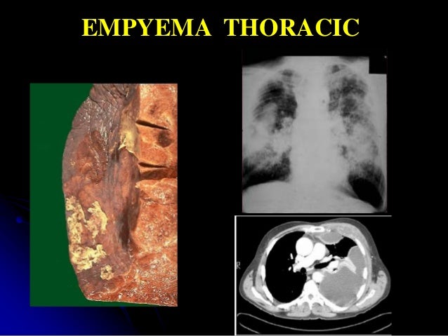 Aetiopathogenesis and management of empyema thoracis