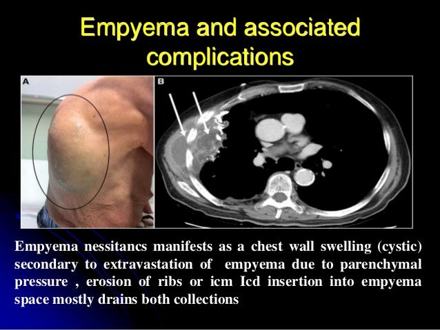 Aetiopathogenesis and management of empyema thoracis