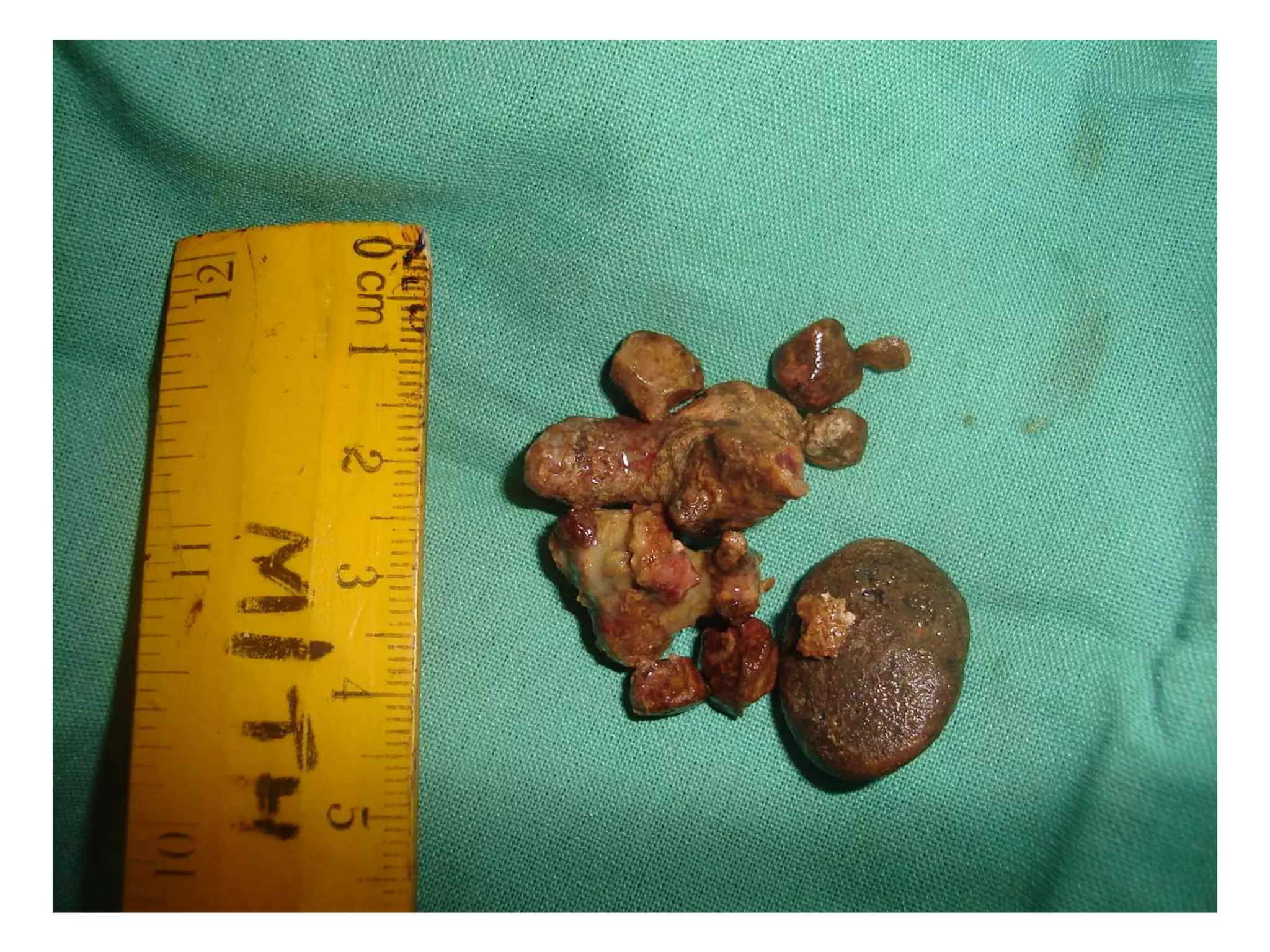 Aetiopathogenesis and treatment of urolithiasis | PPTX | Chemistry ...